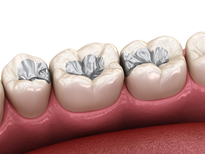 How Dental Fillings Prevent the Onset of Tooth Decay?